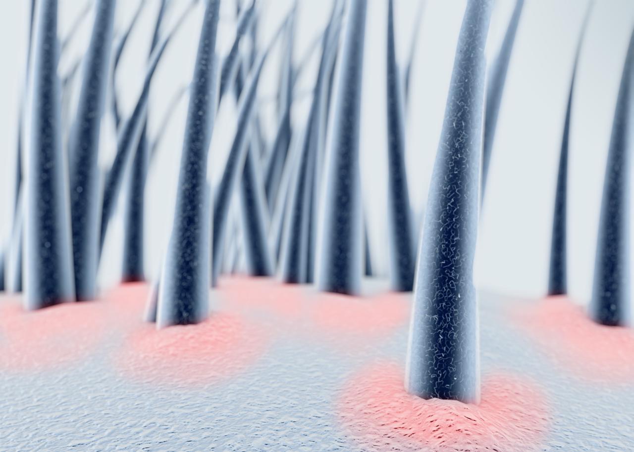 Desincruste Capilar e Peeling Ultrassônico - Simone Neri